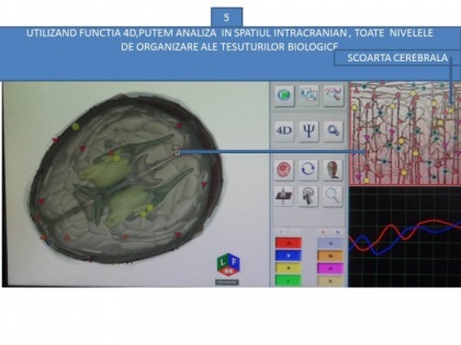 Scleroza Multipla - Cu Determinsm Plurifactorial Infectios